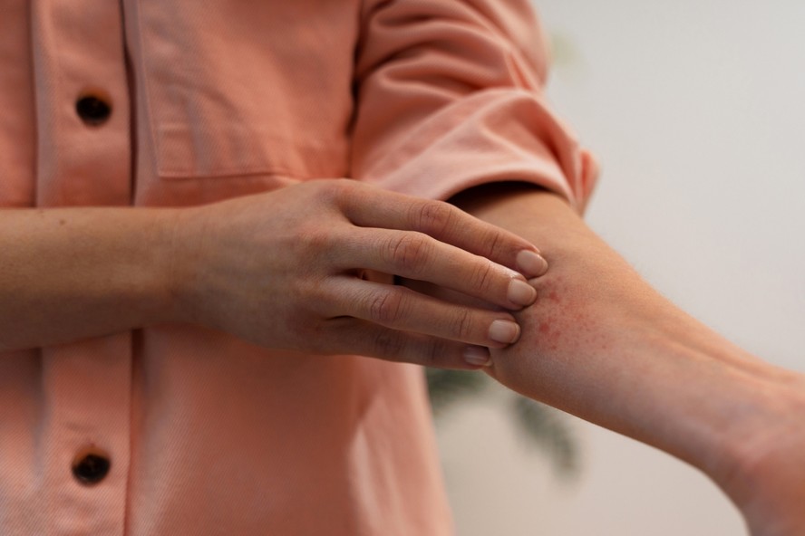 Como distinguir as picadas de diferentes insetos?